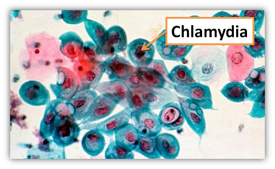 Bệnh đường tình dục: Chlamydia – the tiny pharmacist